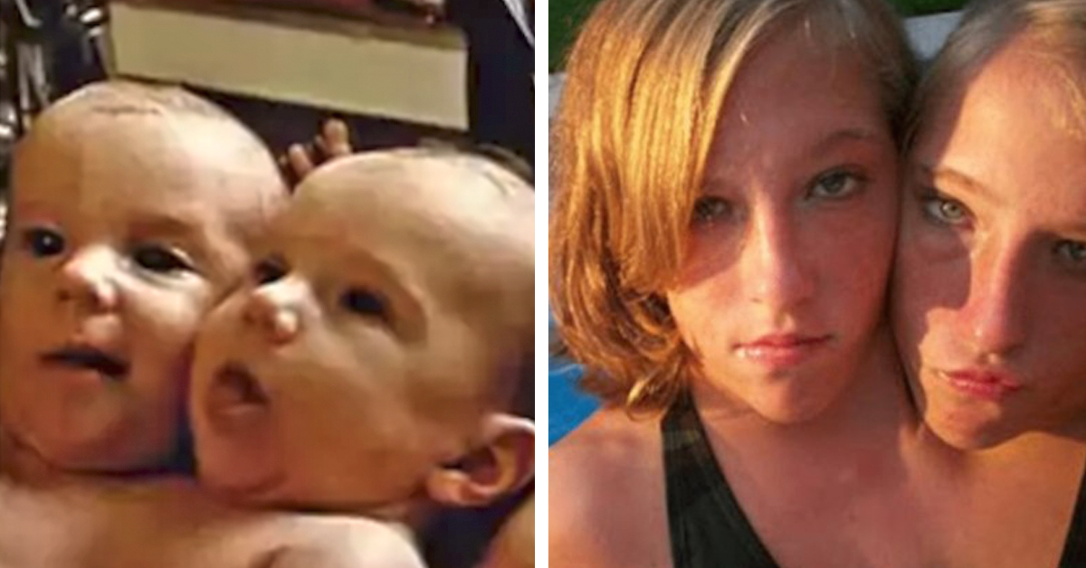 They are the only set of female dicephalus twins to survived infancy ...
