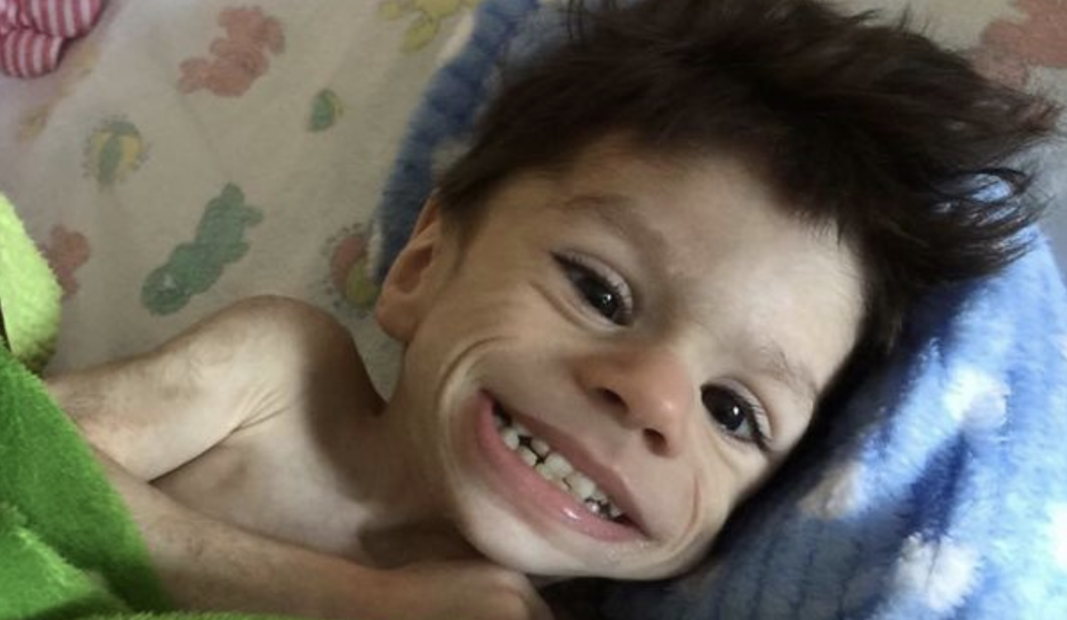 Starving 8-Year-Old Orphan Who Weighed Only 8 Pounds Now Looks ...