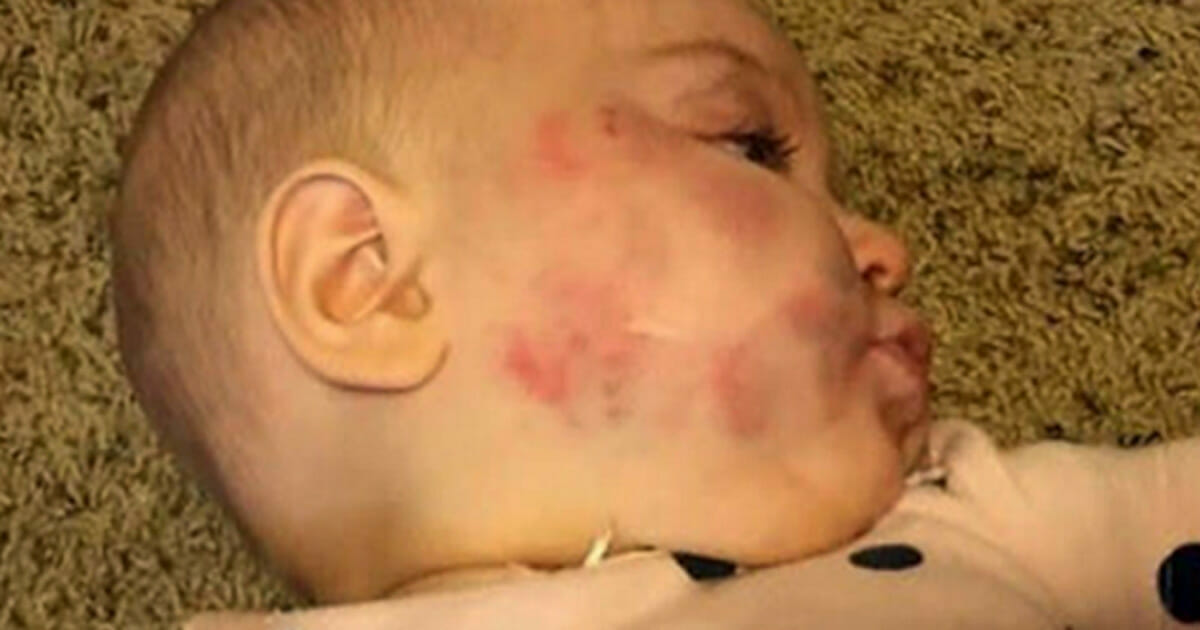After getting call Mom rushes to preschool and sees bite marks all over ...