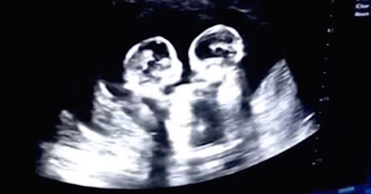 Identical Twin Sisters Spotted ‘Fighting’ in Mom’s Womb During ...